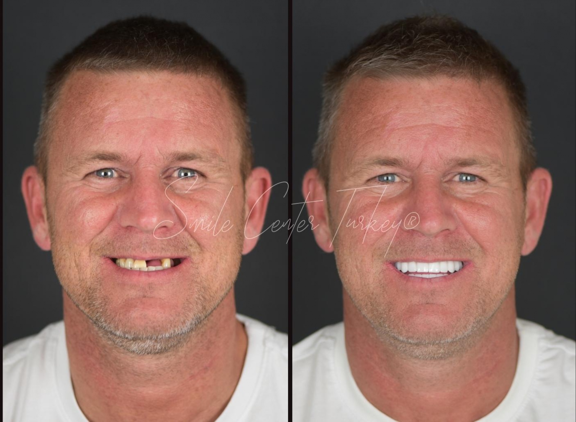 Turkey Teeth: The Complete UK Guide - Smile Center Turkey®