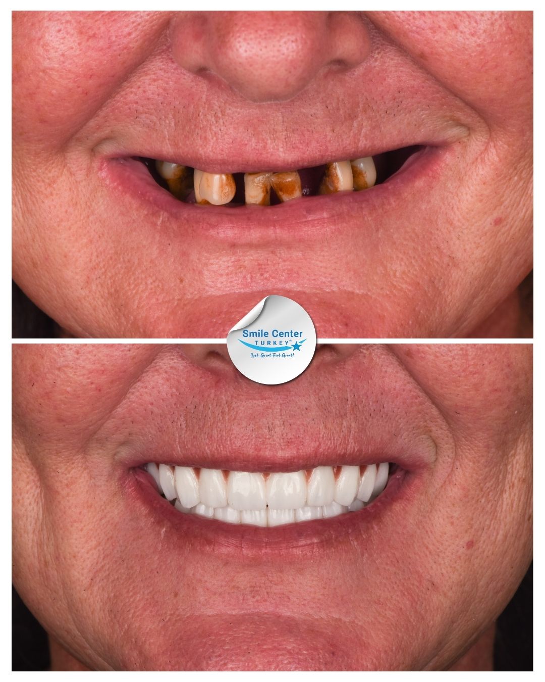 Debbie D. - Smile Center Turkey®