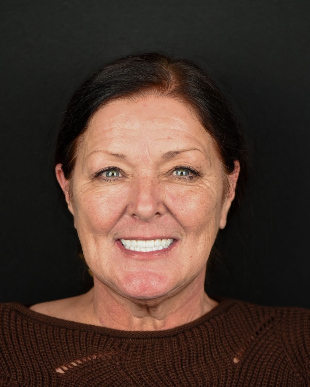 Debbie D. - Smile Center Turkey®